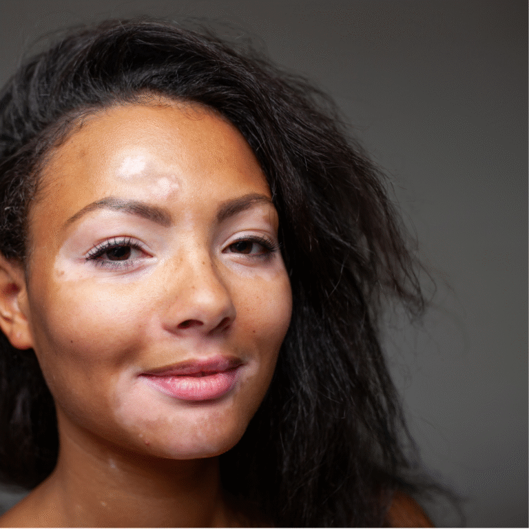 Alopecia & Vitiligo Landing Page - Bio Research Partner